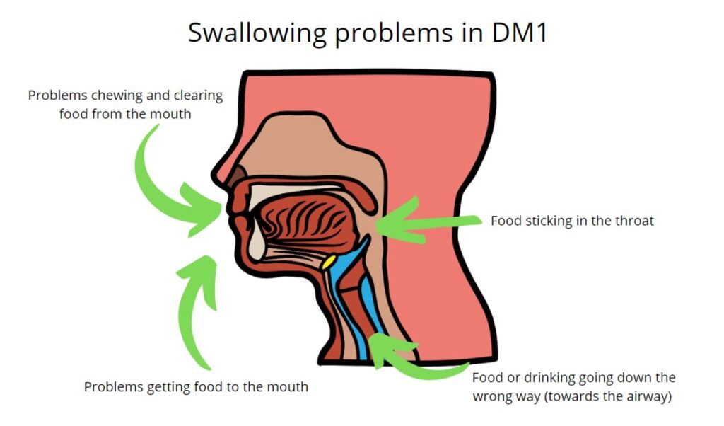 Swallowing Difficulties in Myotonic Dystrophy Type 1 (DM1) - Myotonic Dystrophy Support Group